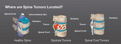 Spine Tumours And Infections Spine Sure Clinic