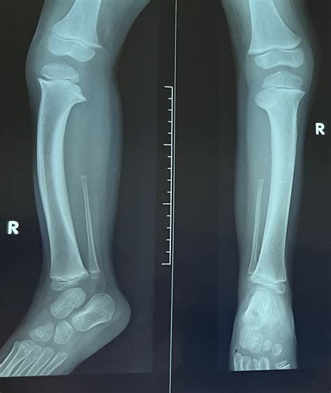 Fibular Hemimelia X Ray