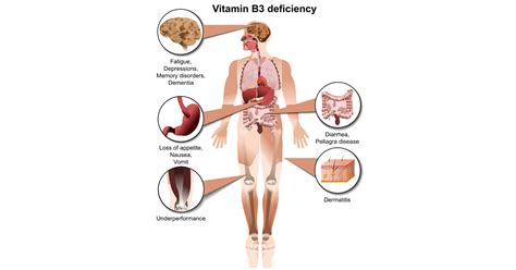 Vitamin B3 Deficiency Symptoms Causes Treatment And Prevention