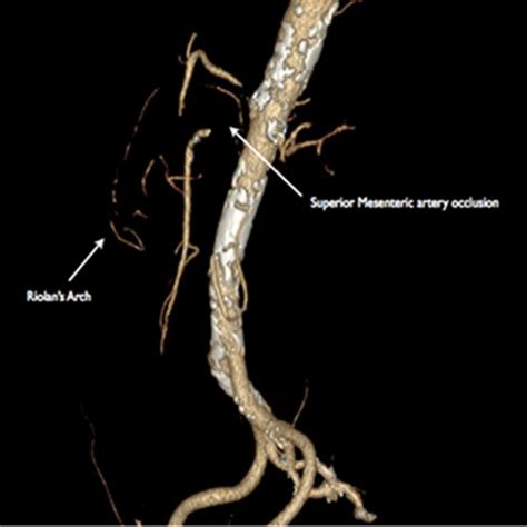 Retrograde Revascularization Of Superior Mesenteric Artery Direxion