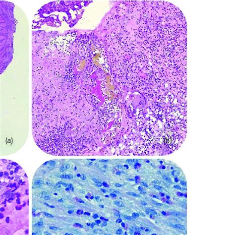 Biopsy Of The Posterior Wall Of The Urinary Bladder Compatible With