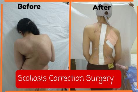 Best Scoliosis Treatment Surgeon Doctor Specialist Noida Delhi Gurgaon India