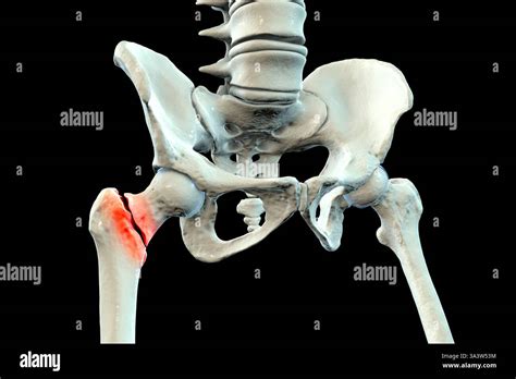 Illustration Of A Basicervical Femur Fracture Showing A Break At The Base Of The Femoral Neck