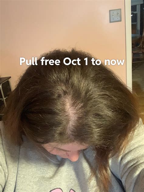 Trying Rtrichotillomania