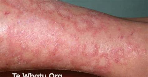 Dermnet® Erythema Annulare Centrifugum Image