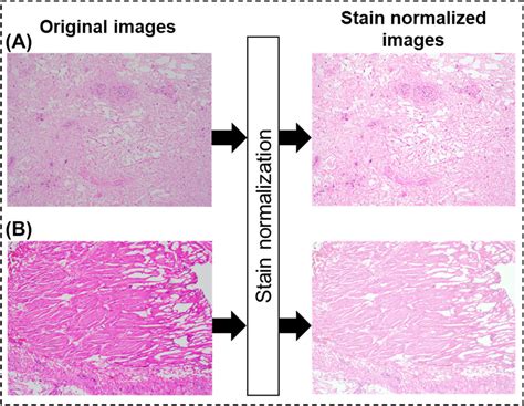 Effect Of Reinhard Stain Normalization On Hande Stained Histopathological
