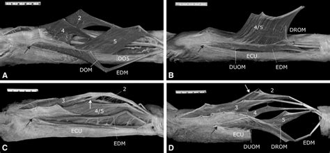 Extensor Digiti Minimi Edm Ot Compartments Superficially Opened To