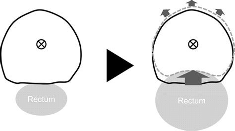 A Schematic Of Prostate Deformation Obtained By Aligning Of The