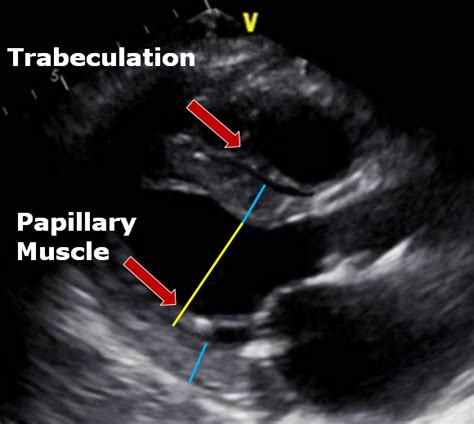What Is Lvidd On Echocardiogram