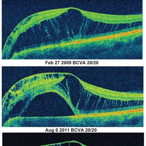 Observed Patient With Progression Of Schisis Like Cavity Over 6 Year