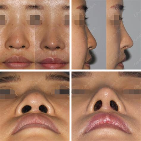 Closed Rhinoplasty Bulbous Nose Droopy Nose Flat Nose Columella