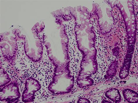 All Of The Lesions Were Pathologically Diagnosed As Sessile Serrated