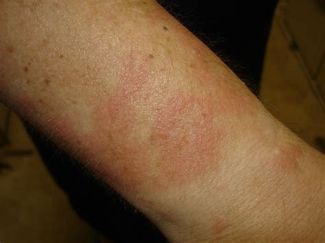 As My Fibro World Turns Red Thick Scaly Rash Photos
