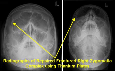 Zygomatic Fracture Complications Sjcxy