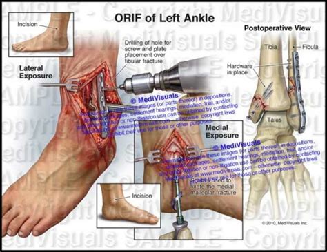 Orif Of Left Ankle Medivisuals Inc