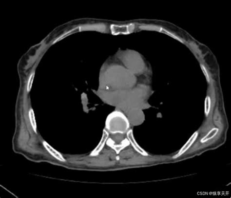 Dicom核心概念：显式 Vr（explicit Vr）与隐式 Vr（implicit Vr）在dicom中的定义与区别dicom Vr Csdn博客