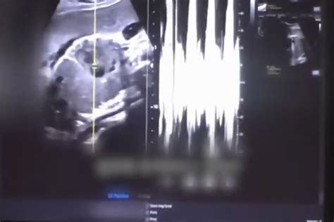 韓女懷孕36周墮胎還拍vlog！ 主刀醫生稱「取出死胎」拒認謀殺 星島日報