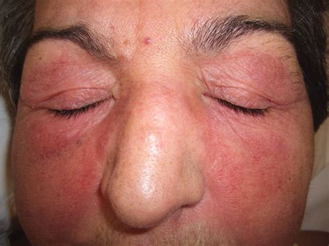 Dermatomyositis Chest