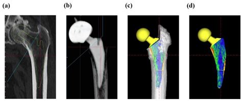 Jcm Free Full Text Relationship Between Stress Shielding And Optimal Femoral Canal Contact