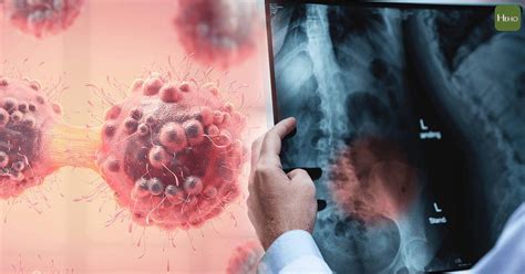 25％癌末病人會骨轉移 乳癌、攝護腺癌、肺癌是高危險群 Heho健康 Line Today