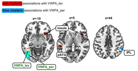 Structural Covariance Map Of Grey Matter Volume In The Lexical Part Of Download Scientific