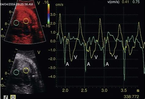 Fetal Arrhythmias Radiology Key