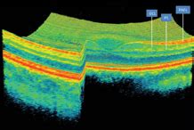Multiple Sclerosis Can Be Measured By OCT