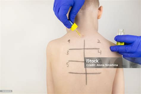 실험실에 있는 알레르기 제스트는 알레르기 찌르기 시험을 지휘합니다 가정 음식 표피 알레르기 반응에 대한 피부 테스트 시험은