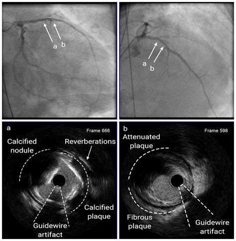 Case 5 Ivus Guided Pci In Acs Cardiology Apps