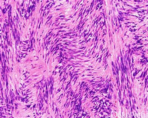 淋巴结内栅栏状肌纤维母细胞瘤
