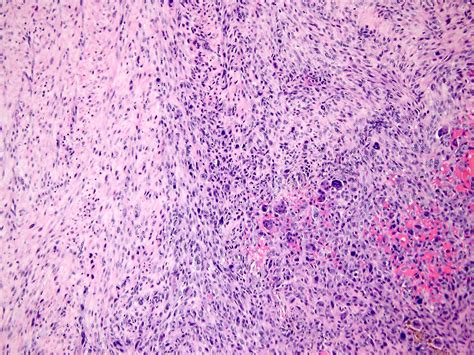 Pathology Outlines Leiomyosarcoma General