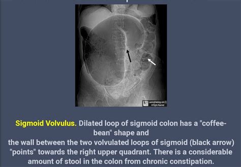 Sigmoid Volvulus Coffee Bean Sign
