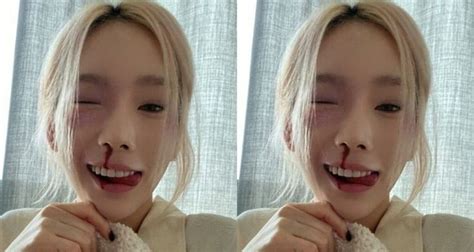 피멍에 코피… 소녀시대 태연이 올린 사진에 깜짝 놀란 팬들 사진 소녀시대 태연