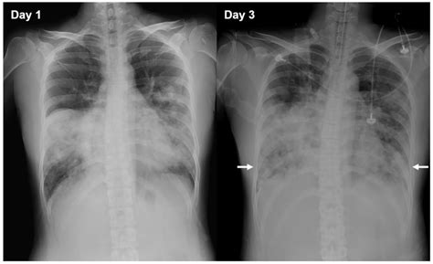 Mycoplasma Pneumoniae X Ray