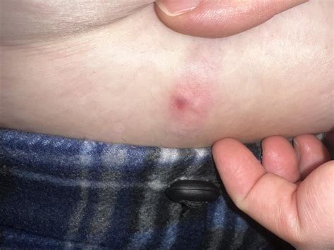 Aching And Sensitive Under Belly R Skin