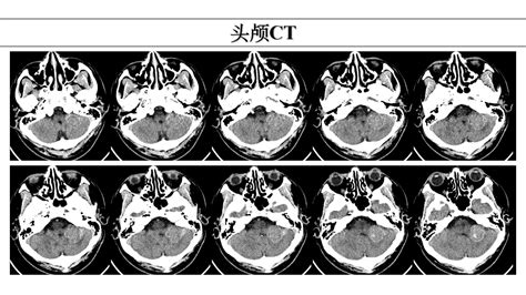 病例分享03：枕下乙状窦后入路左侧小脑半球海绵状血管瘤切除术 新疆自治区人民医院董军主任团队 脑医汇