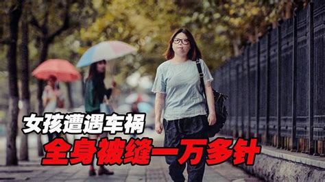 补丁女孩，身上被缝了1万多针，依然用笑脸面对世界情感正能量好看视频