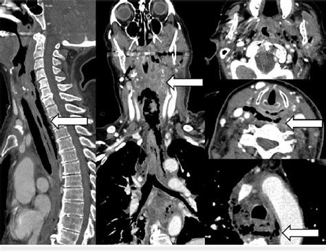 Left Masticator And Parapharyngeal Space Abscess Complicating With