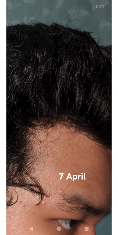 Visible Thinning Rminoxidil