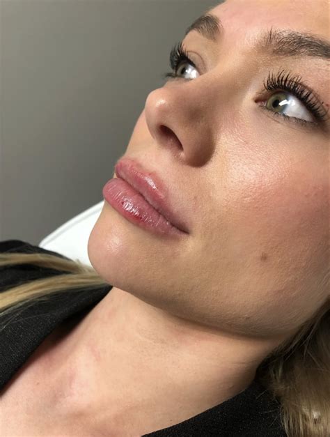 Aesthetics By Abby Botox Services Dermal Filler Services