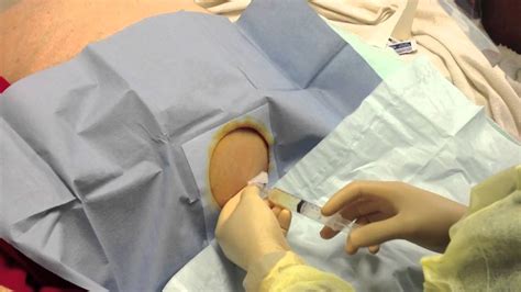 Spontaneous Bacterial Peritonitis Sbp Rebel Em Emergency Medicine Blog