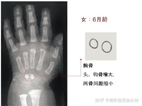 详解骨龄标准g P骨龄图谱法（女孩版） 知乎