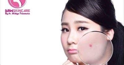 How To Prevent Pimple Permanently 14 Tips