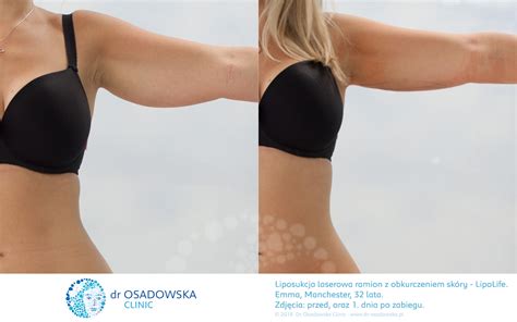 Zdjęcia Liposukcja ramion efekty przed i po zabiegu LipoLife Poznań