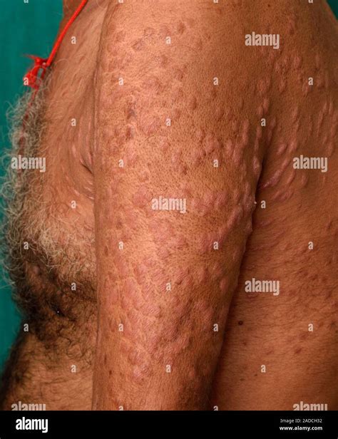 Not For Use In Television Not For Use In Television Diffuse Cutaneous