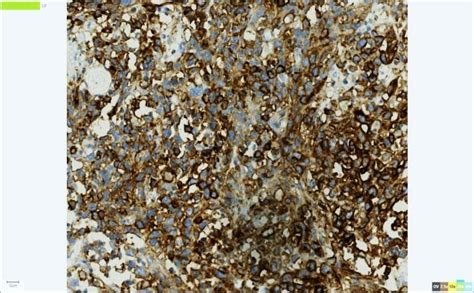 Positive Membranous Staining Of Pdl 1 In A Case Of Invasive High Grade