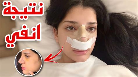 اخيرا نتيجة انفي بعد عملية التجميل 👃🏻 Youtube