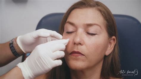 Costos Promedio Del Bótox En Medicina Estética Actualizado Julio 2025