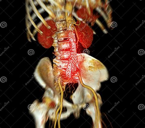 Cta Whole Aorta With Abdominal Aorta Stent Graft Compare 3d Rendering Image Stock Illustration