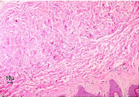 Pseudoxanthoma Elasticum Histology